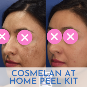 Cosmelan Peel | Cosmelan Depigmentation - Beauty by Dr. Kay